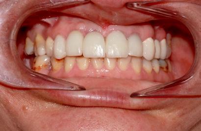 Four extremely decayed front upper teeth