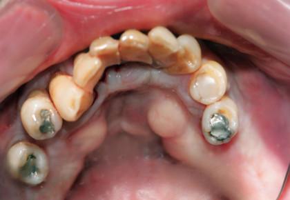 Poor condition of existing teeth due to gum diseases