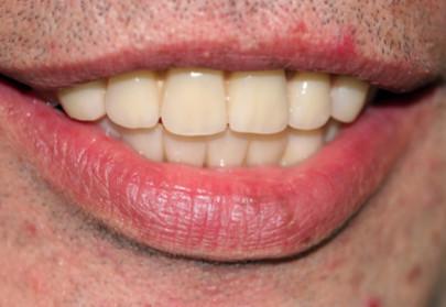 Poor condition of existing teeth due to gum diseases - Surbiton Smile ...