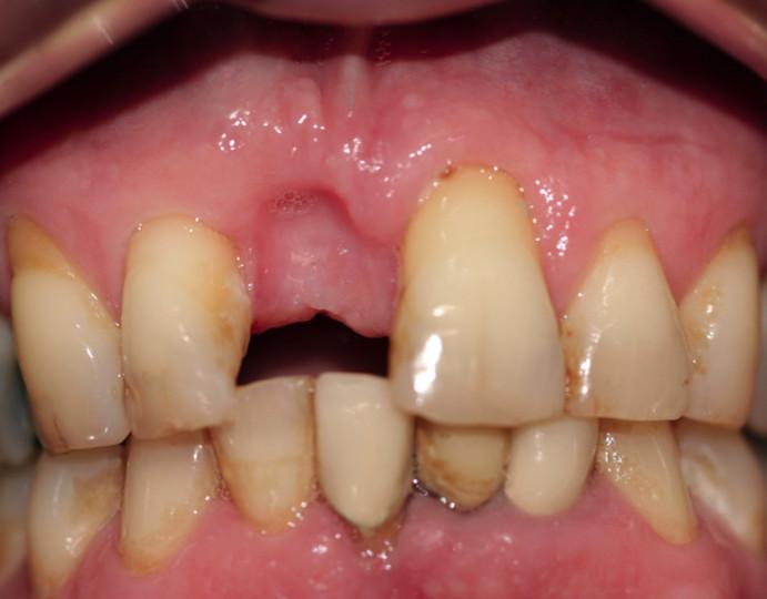 A single front tooth missing due to tooth fracture in upper jaw